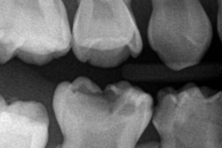 X-Rays (Radiographs) - Dr. Mala Desai & Associates